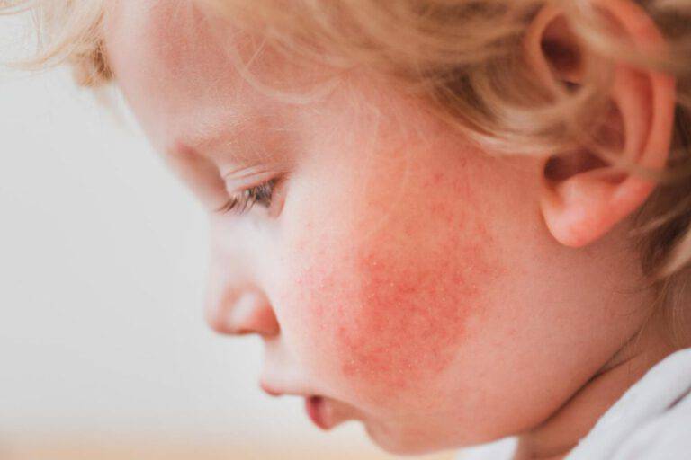 Rush cutaneo nei bambini: le 5 risposte che potrebbero salvargli la ...
